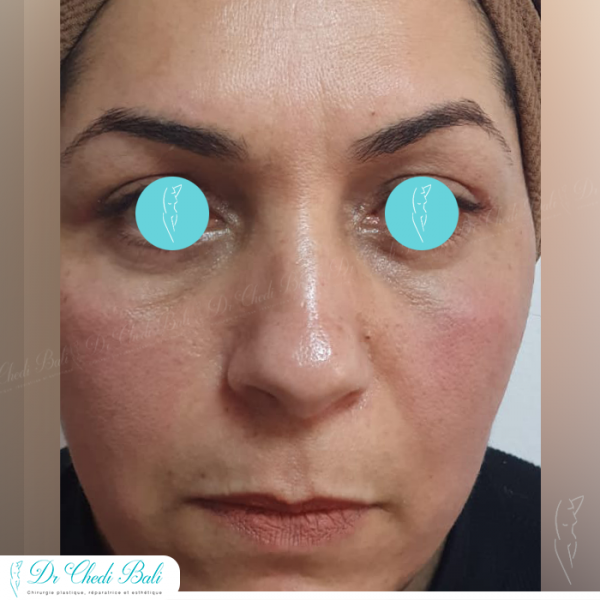 Lippofiling de la face a été associé pour combler les sillons naso ...